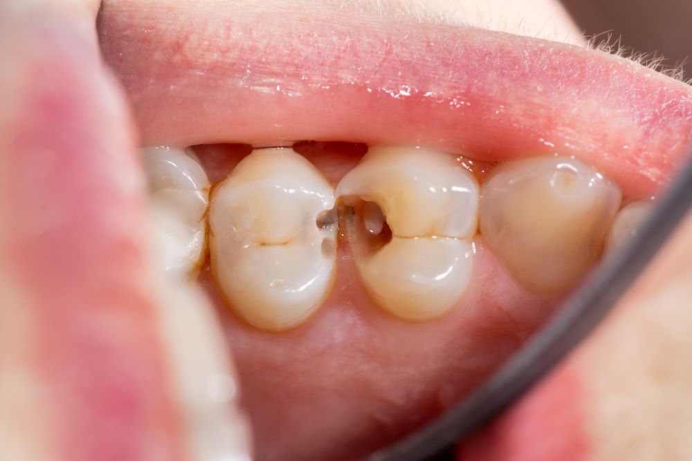 Tooth Decay And Cavities Causes Symptoms And Treatments